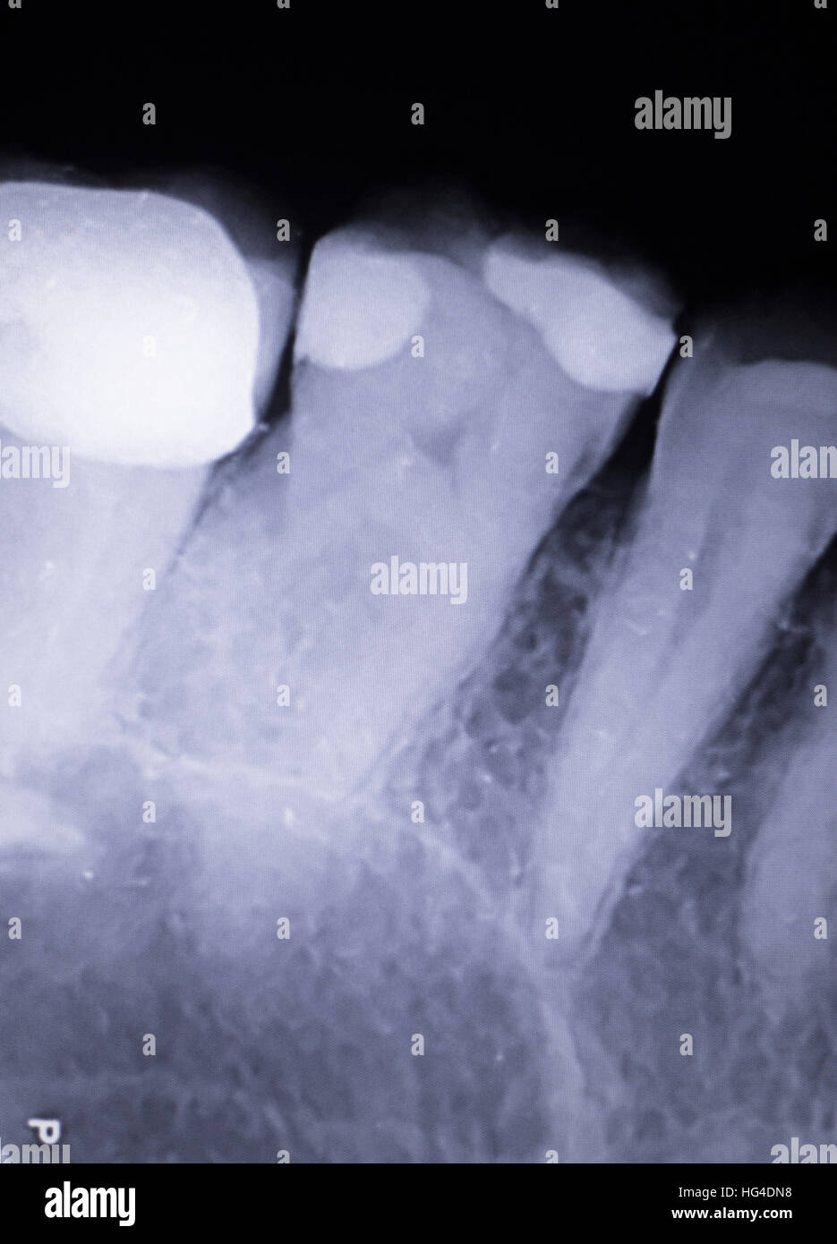 Tooth with filling dental x-ray close-up image showing teeth roots, gum ...