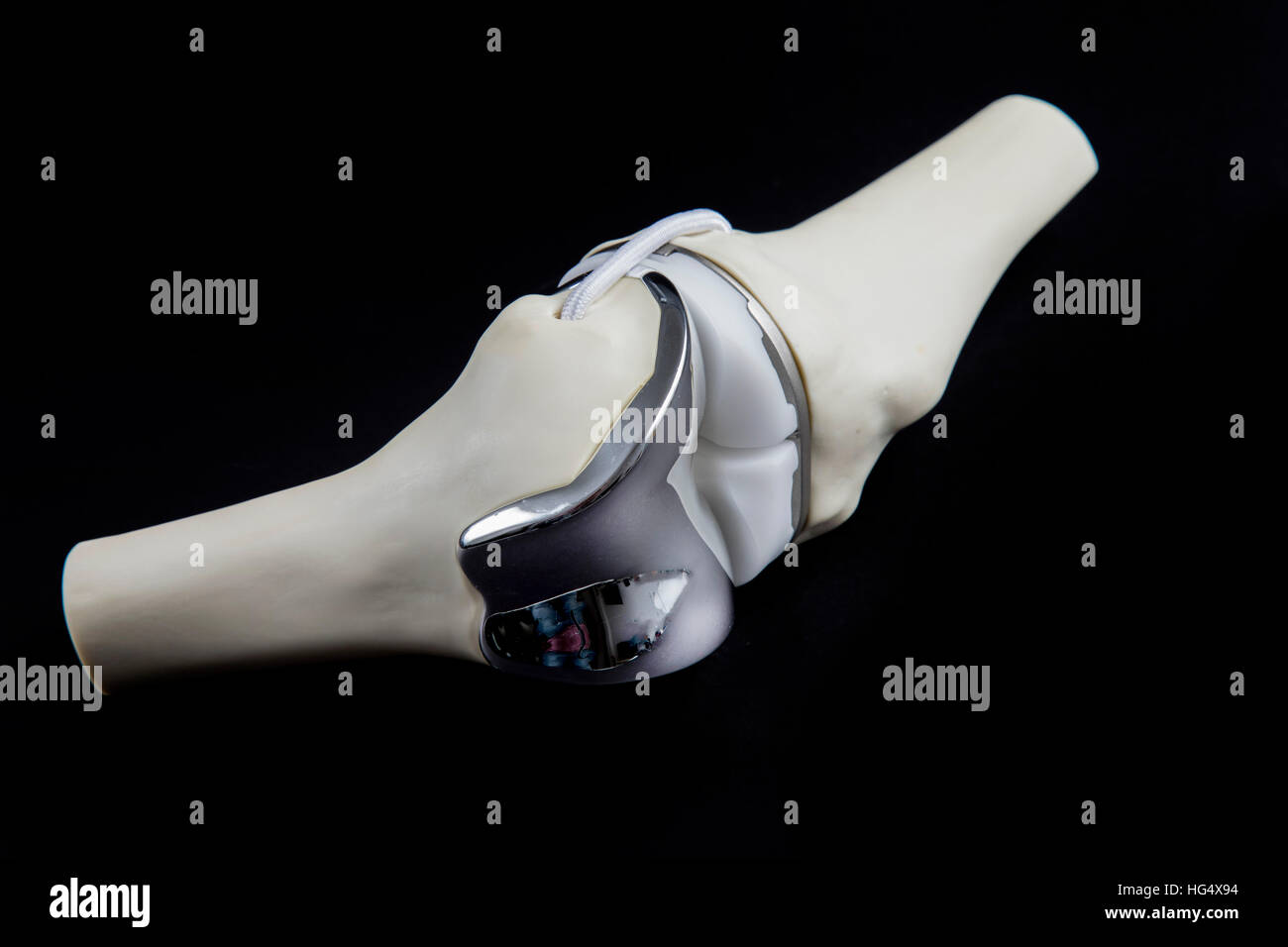 Knee prosthesis, knee endoprosthesis or knee joint prosthesis, on a ...