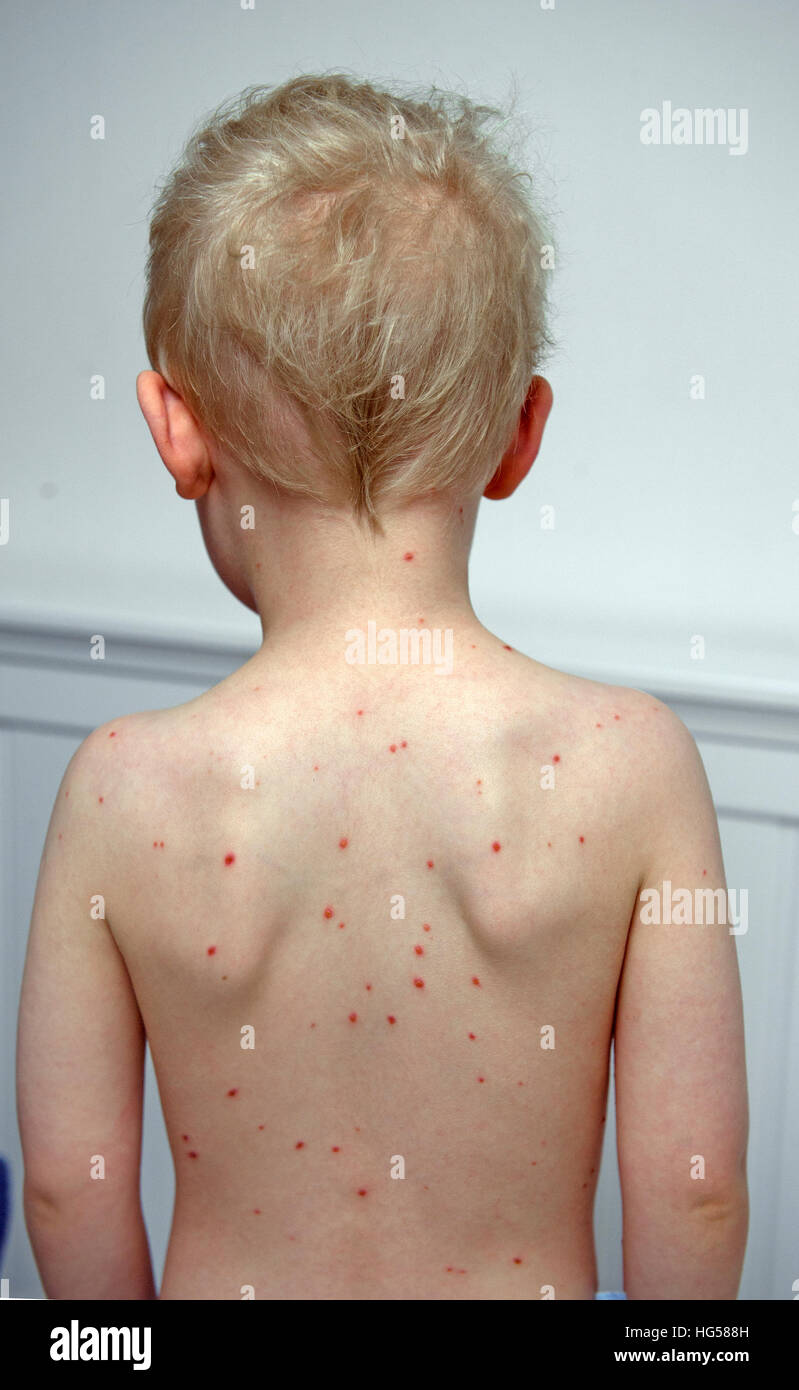 Child Chicken Pox Stock Photos & Child Chicken Pox Stock Images - Alamy
