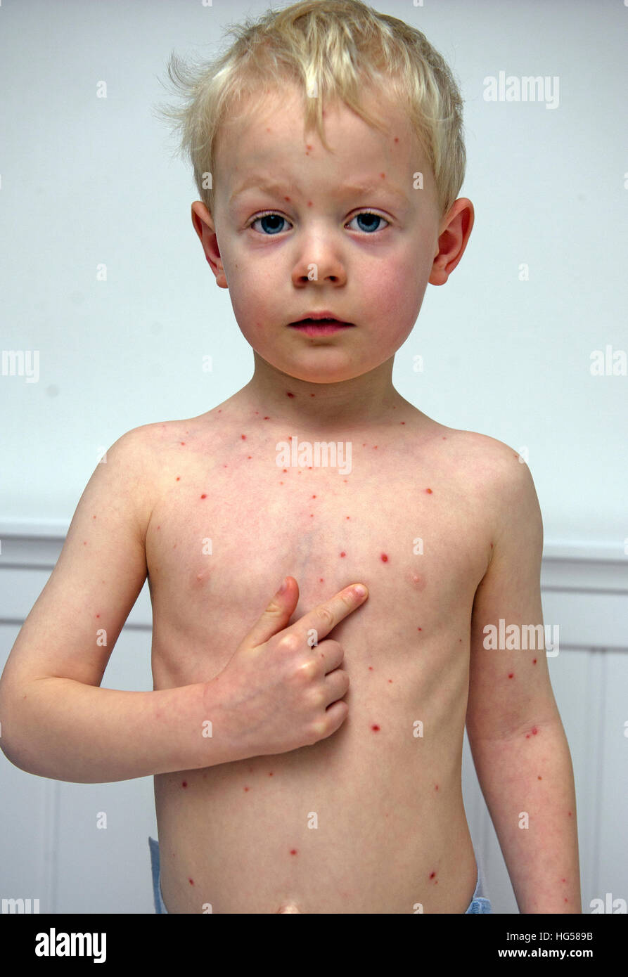 A four year old boy with Chicken Pox on his body Stock Photo - Alamy