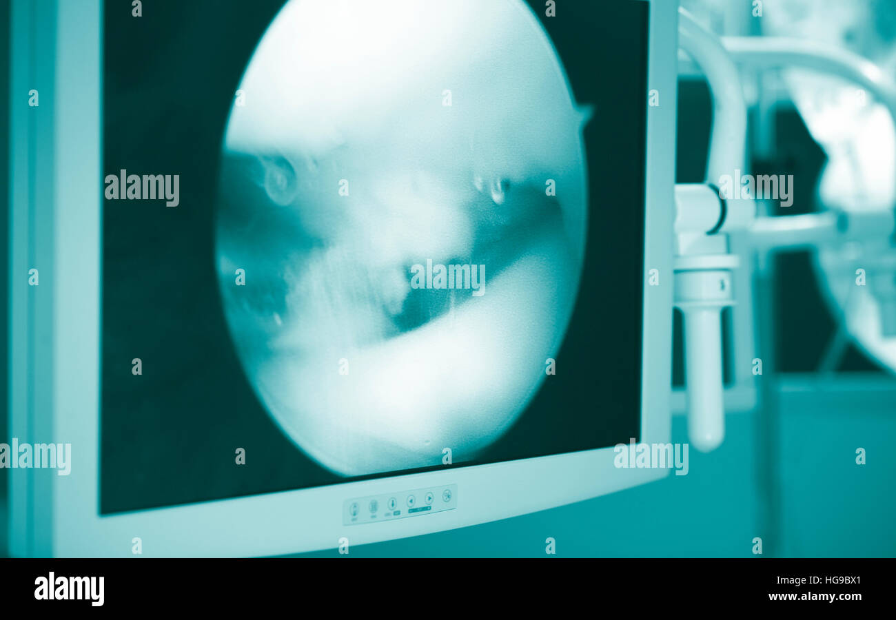 Arthroscopy surgery screen showing arthroscope camera picture in knee ...