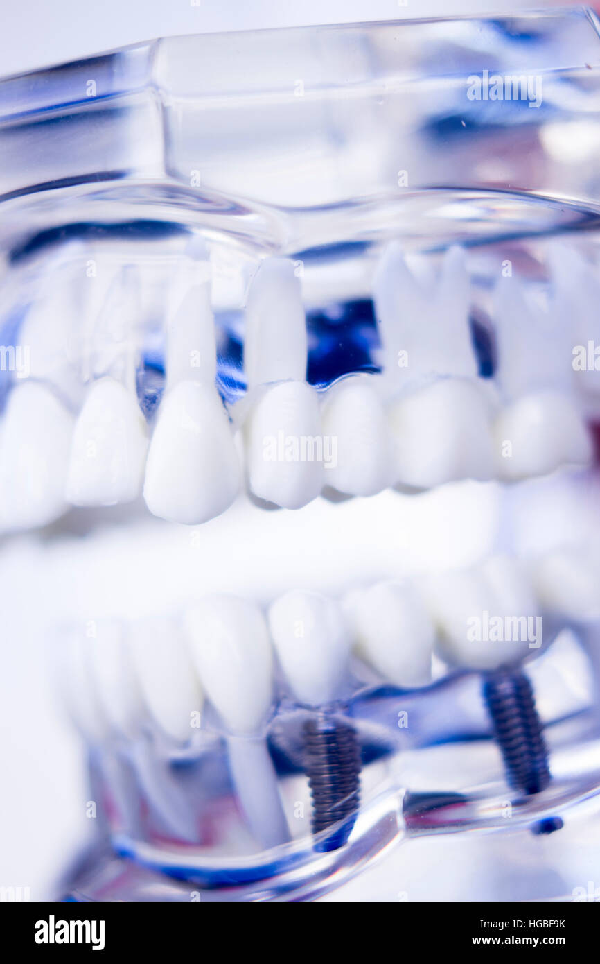 Dentists tooth plastic model with screw implant for teaching, learning ...