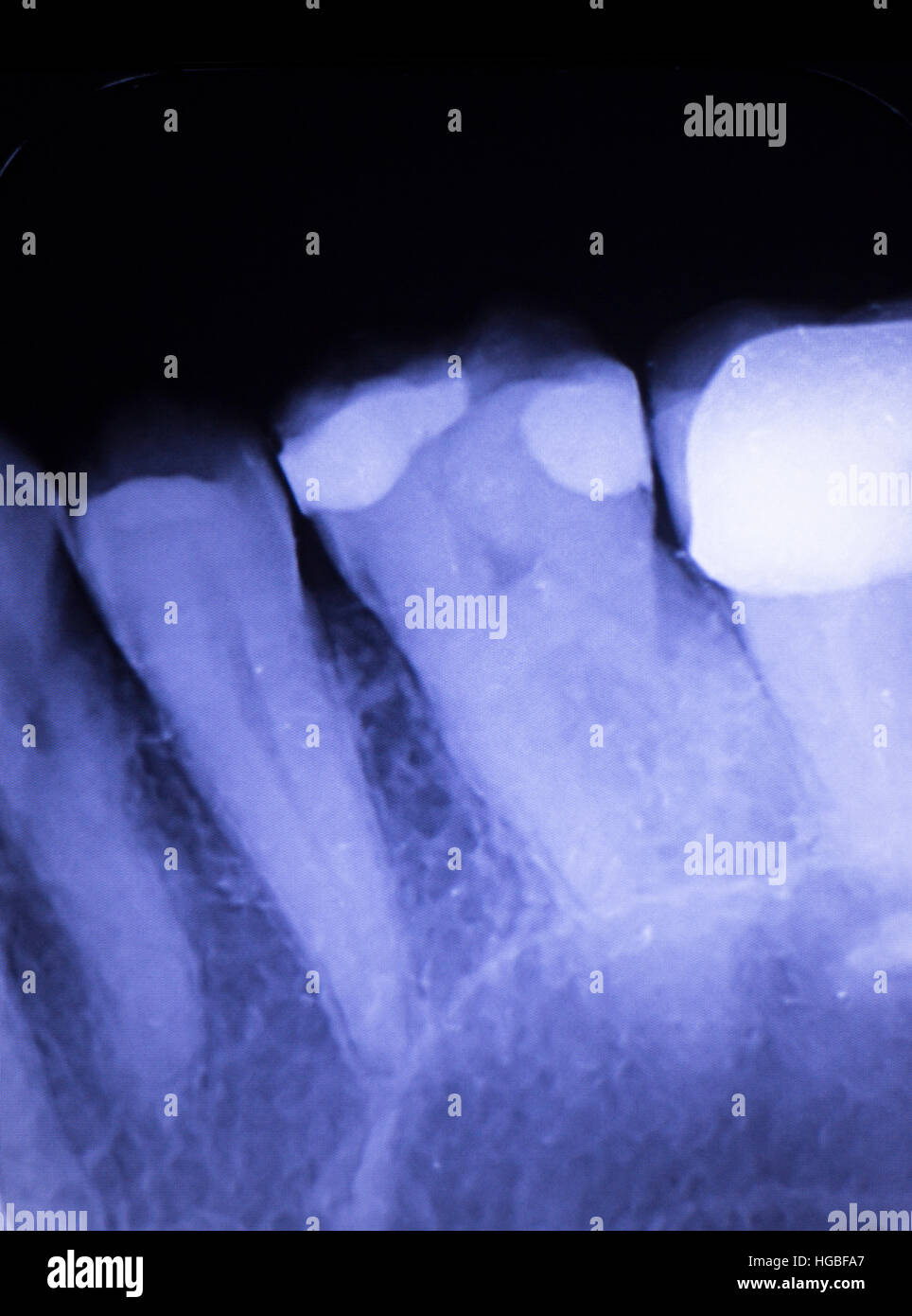 Tooth with filling dental x-ray close-up image showing teeth roots, gum ...