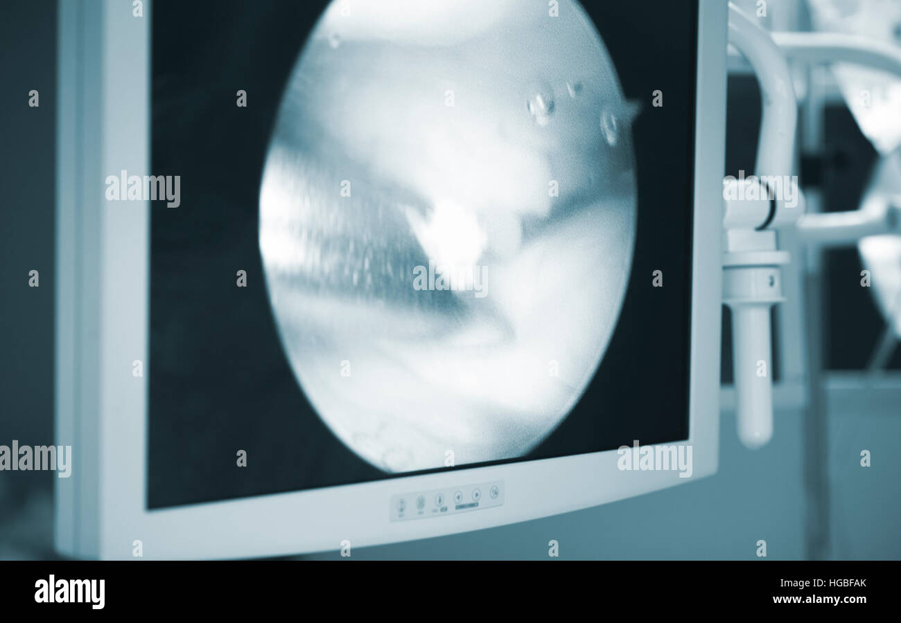Arthroscopy surgery screen showing arthroscope camera picture in knee ...