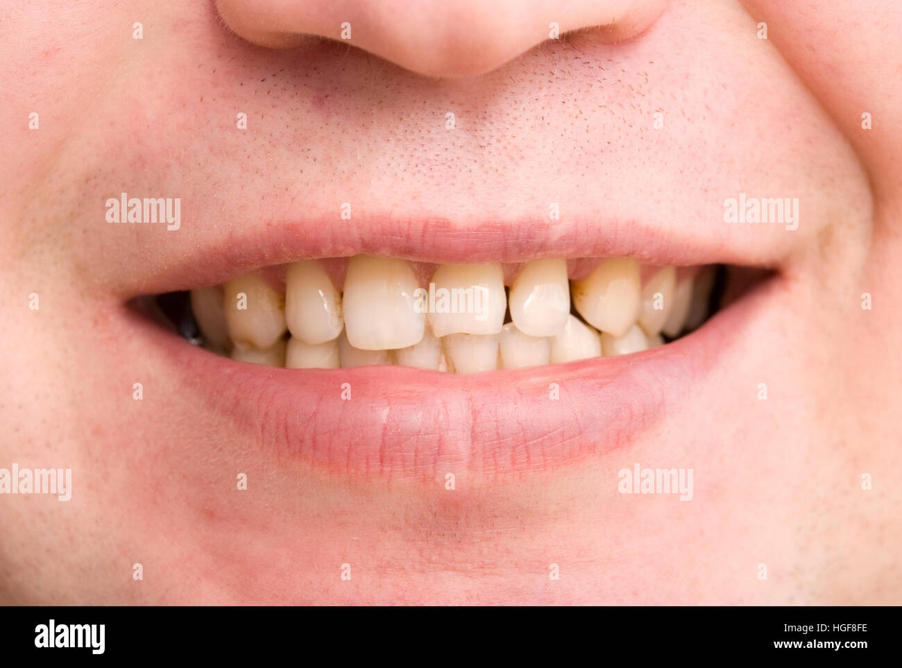 young man with a teeth broken and rotten Stock Photo - Alamy