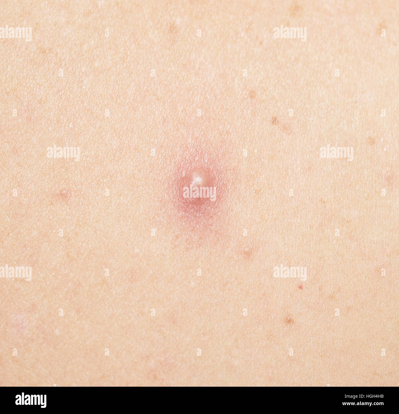 pimple on the skin close-up Stock Photo - Alamy