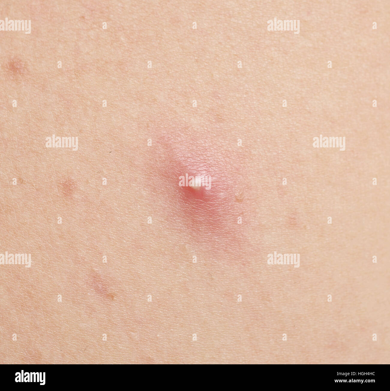 pimple on the skin close-up Stock Photo - Alamy