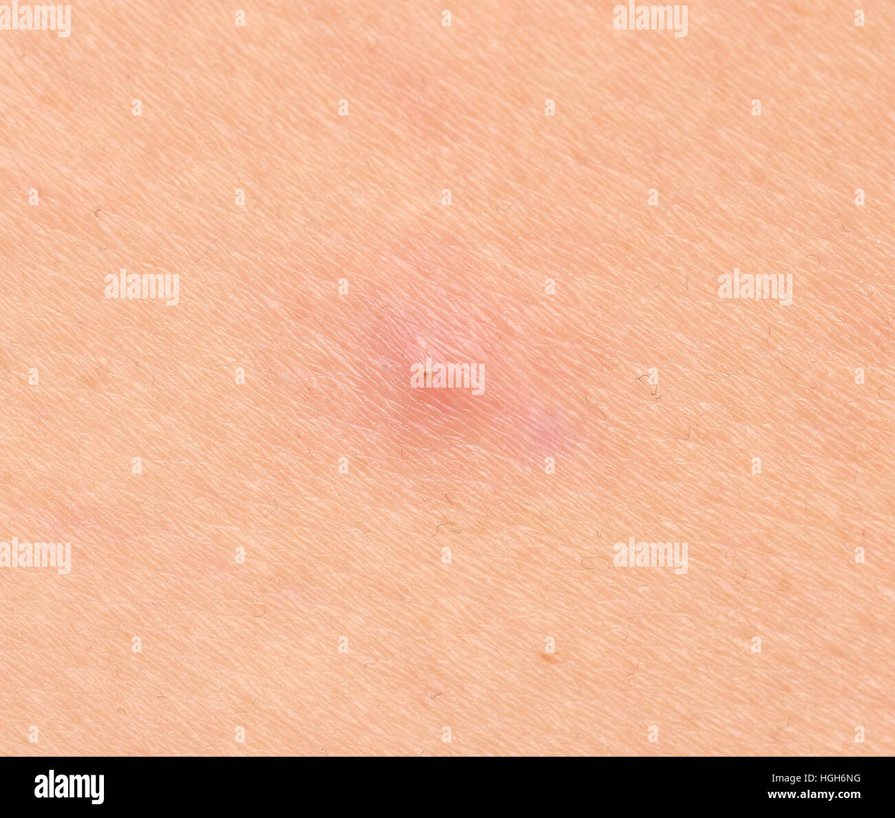 pimple on the skin close-up Stock Photo - Alamy