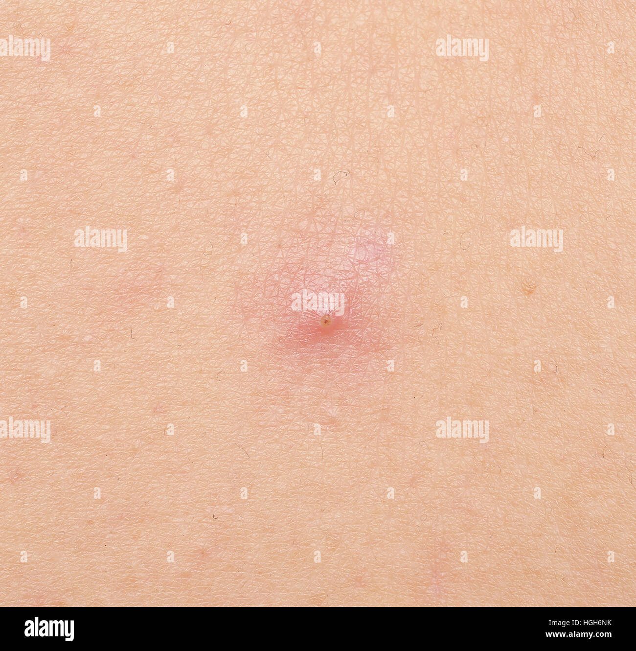 pimple on the skin close-up Stock Photo - Alamy