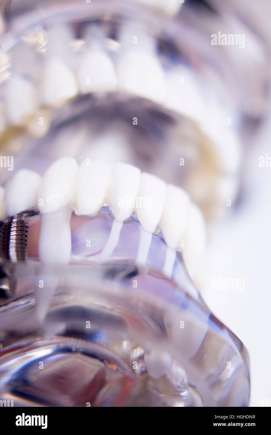 Dentists tooth plastic model with screw implant for teaching, learning ...