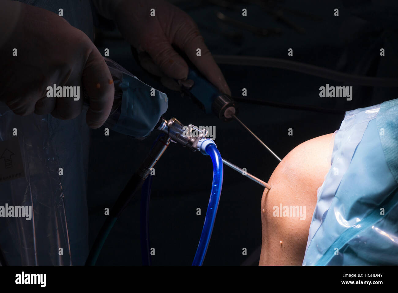 Surgical operation knee arthroscopy micro surgery in hospital operating ...