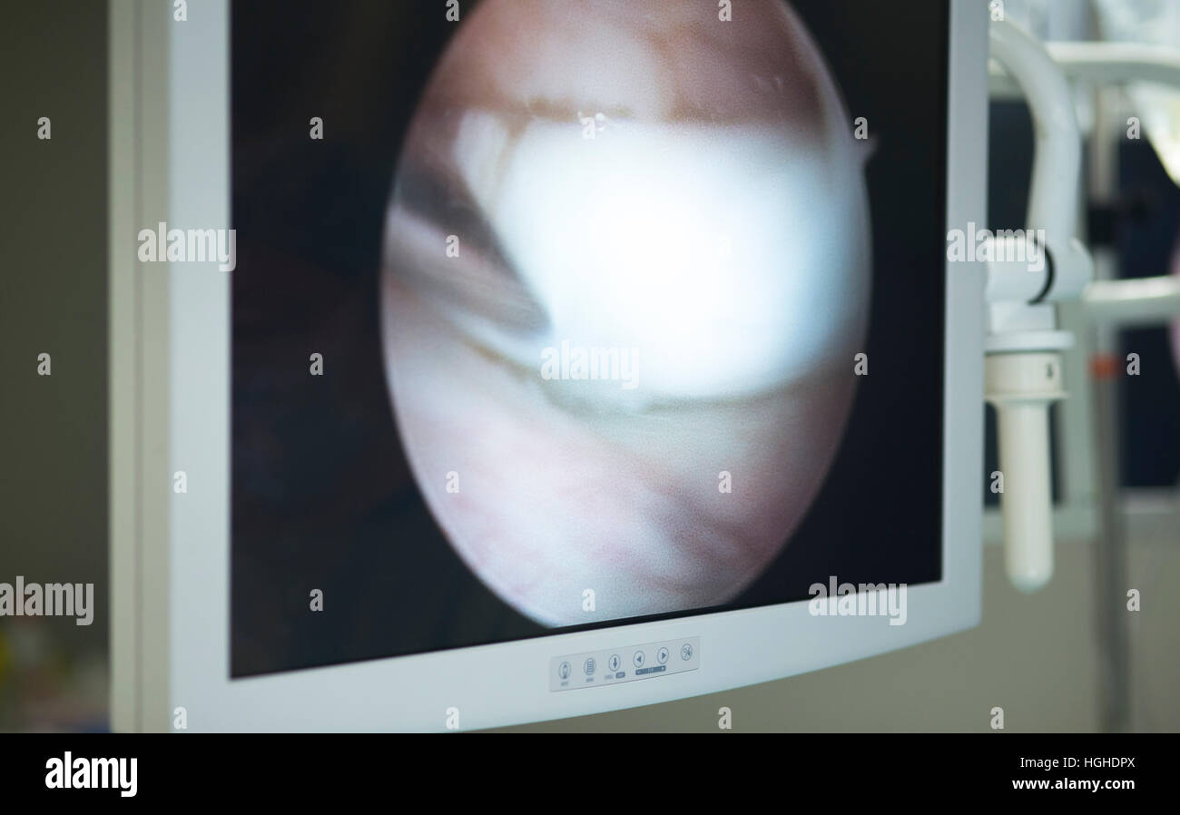 Arthroscopy surgery screen showing arthroscope camera picture in knee ...