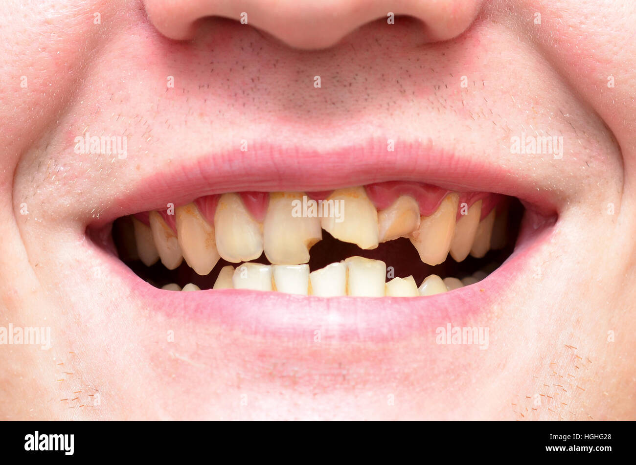 young man with a teeth broken and rotten Stock Photo - Alamy