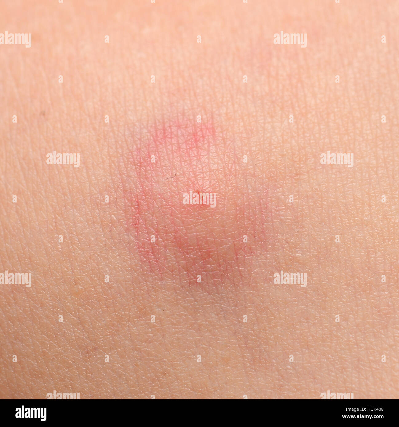pimple on the skin close-up Stock Photo - Alamy