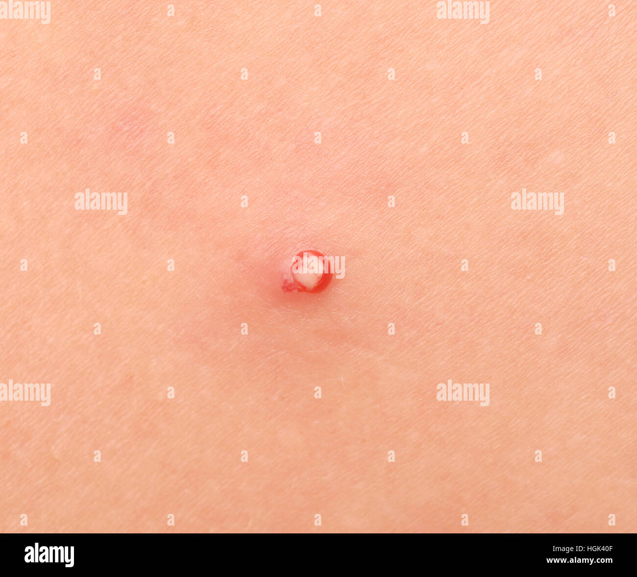 pimple on the skin close-up Stock Photo - Alamy