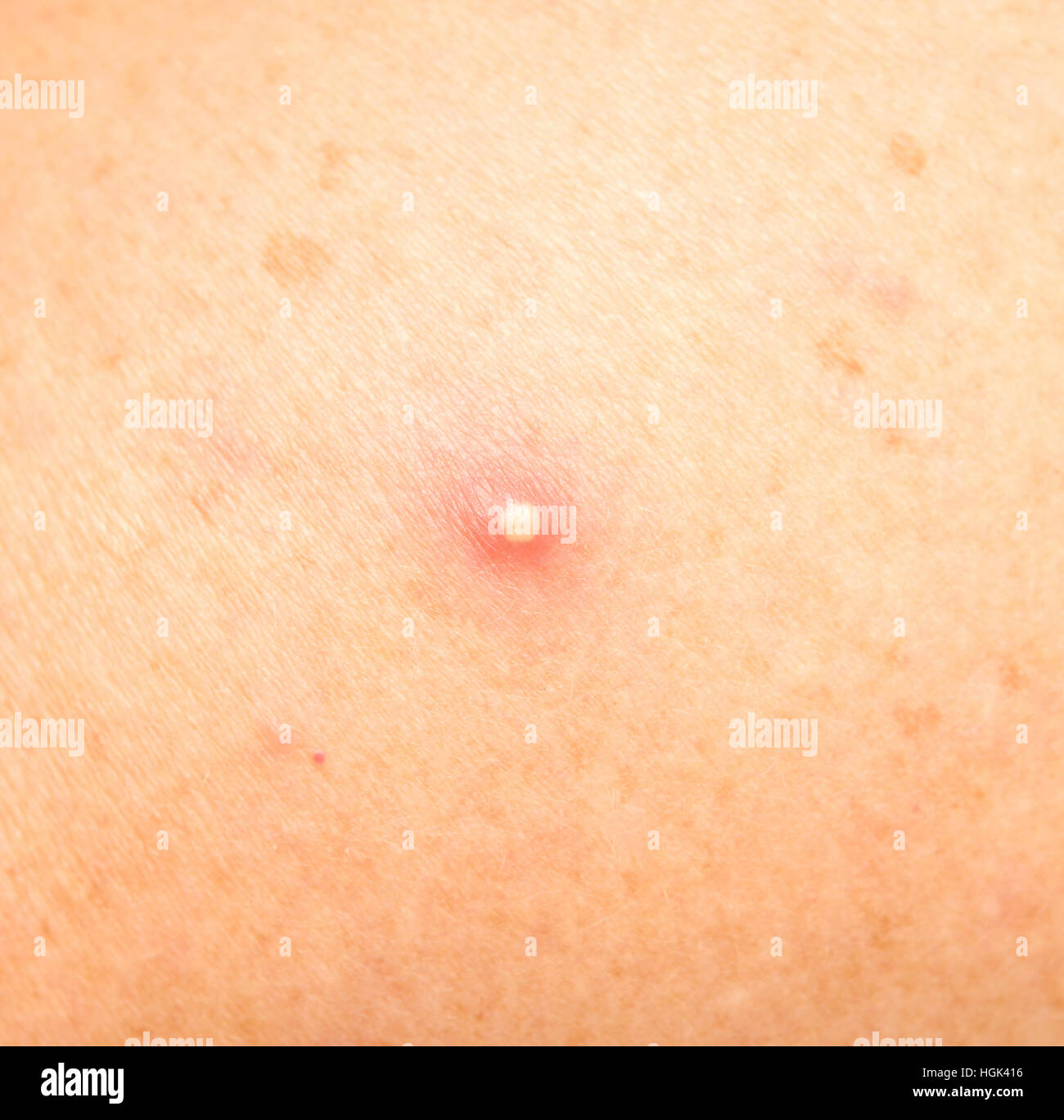 pimple on the skin close-up Stock Photo - Alamy