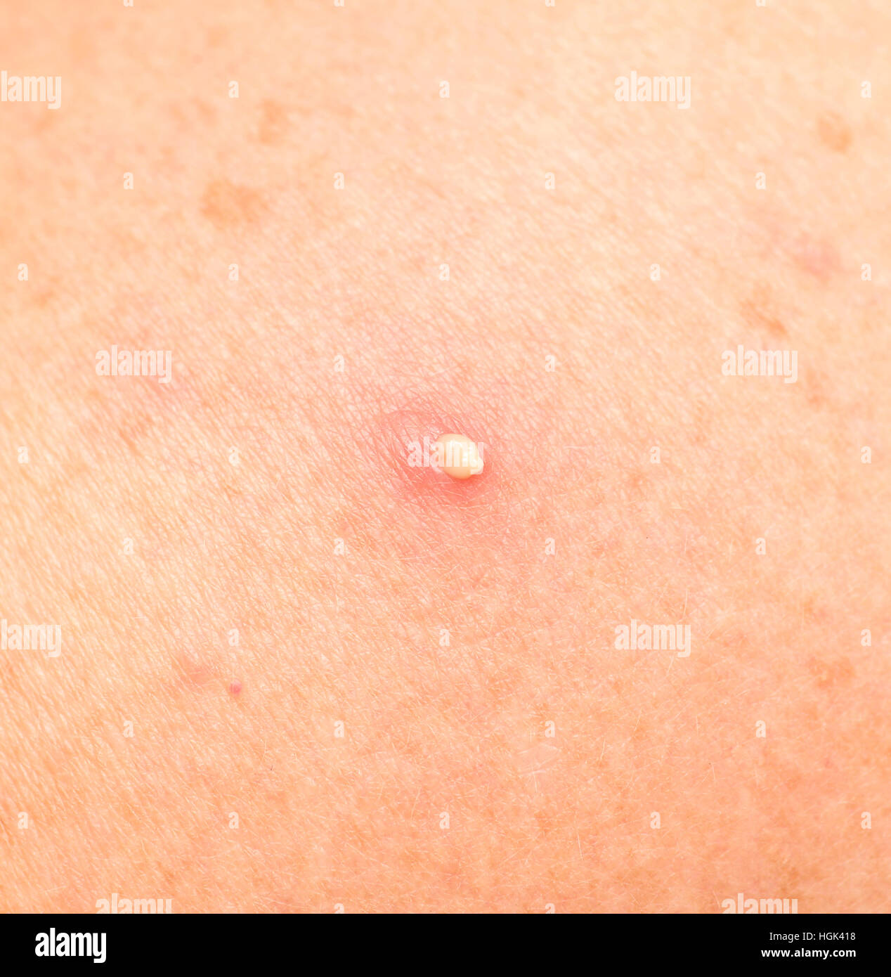 pimple on the skin close-up Stock Photo - Alamy