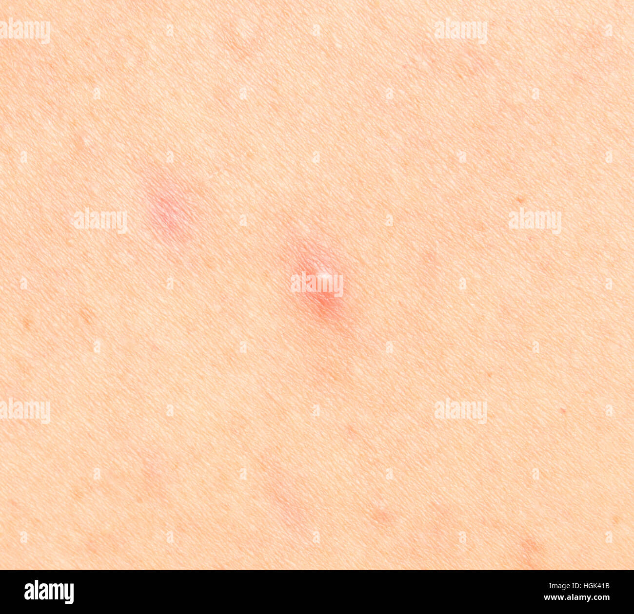 pimple on the skin close-up Stock Photo - Alamy