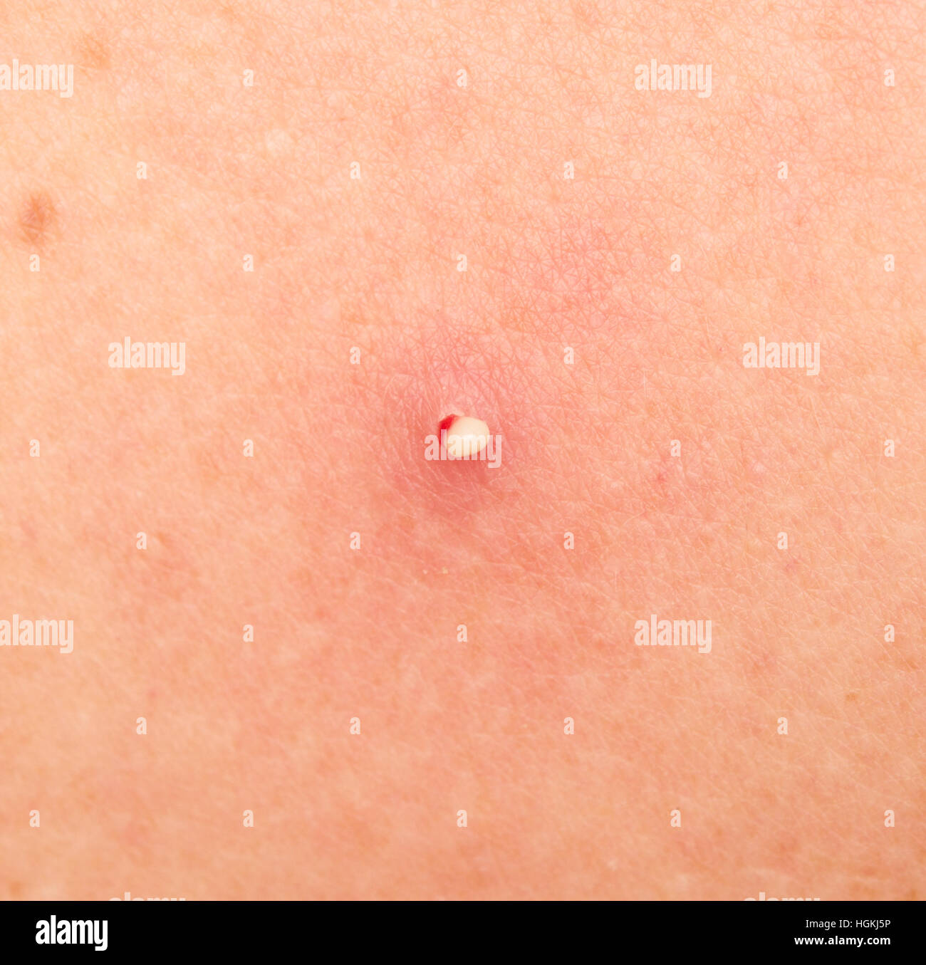 Pimple High Resolution Stock Photography and Images - Alamy