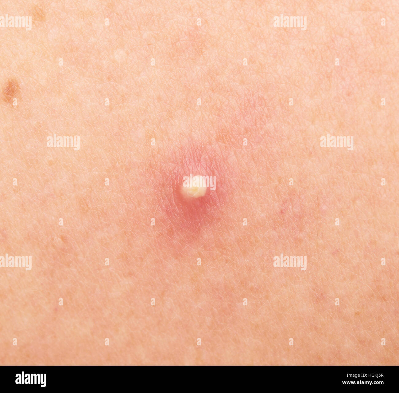 Pimple on skin close hi-res stock photography and images - Alamy
