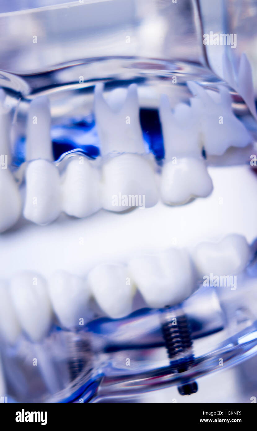 Dentists tooth plastic model with screw implant for teaching, learning ...