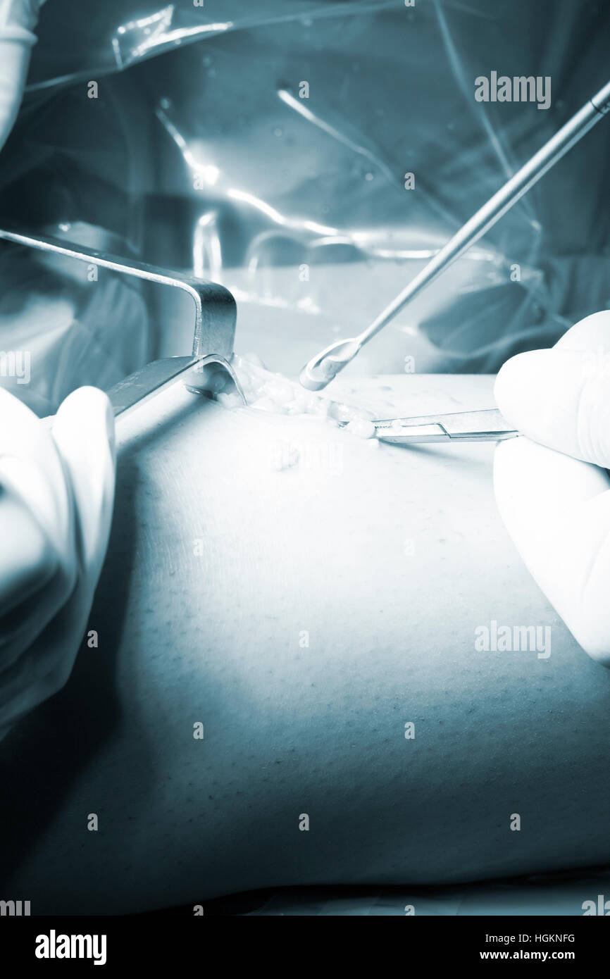 Surgical operation knee arthroscopy micro surgery on knee, tendon ...