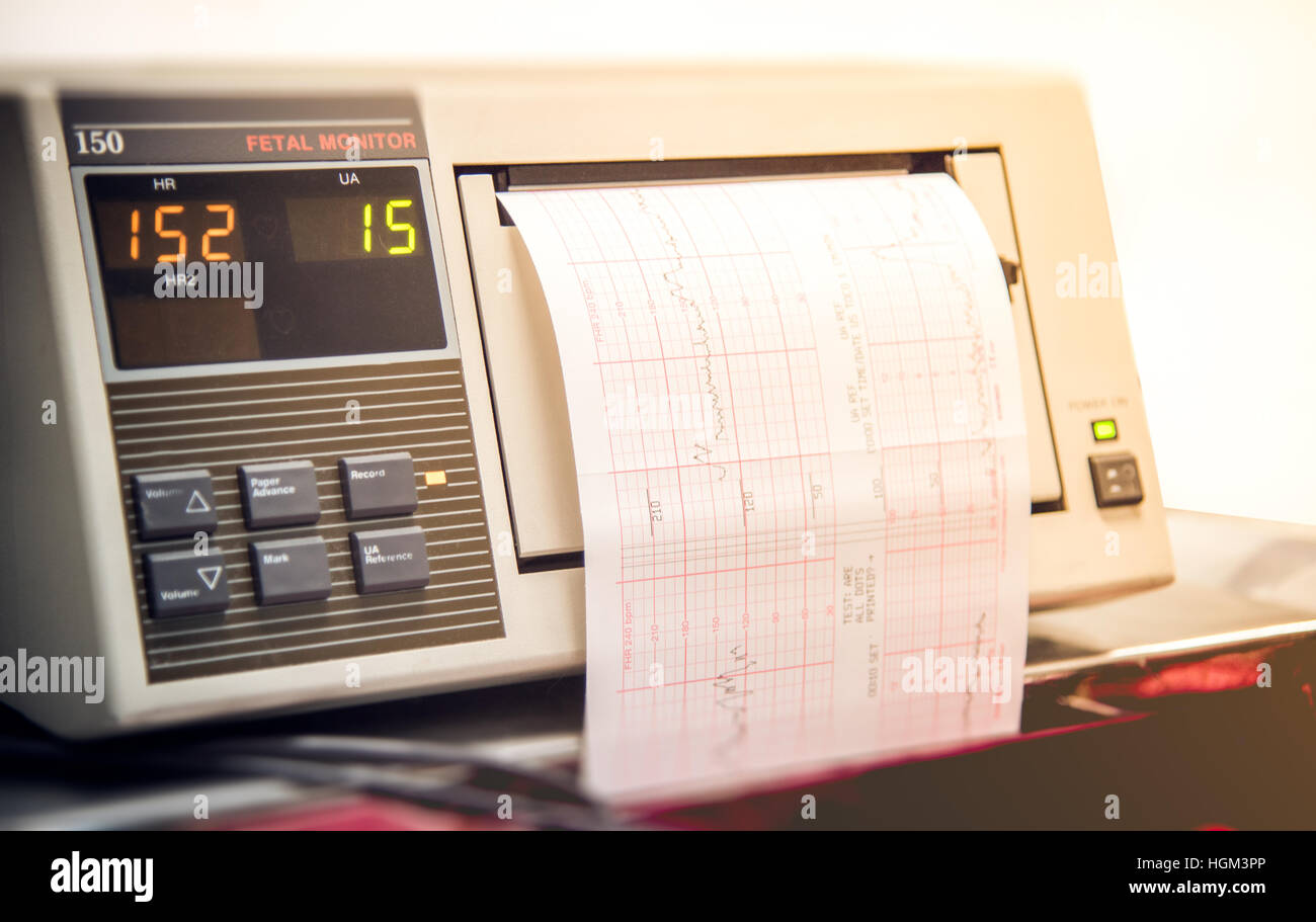 Close up of monitor printout in delivery room tracking baby heartbeat ...