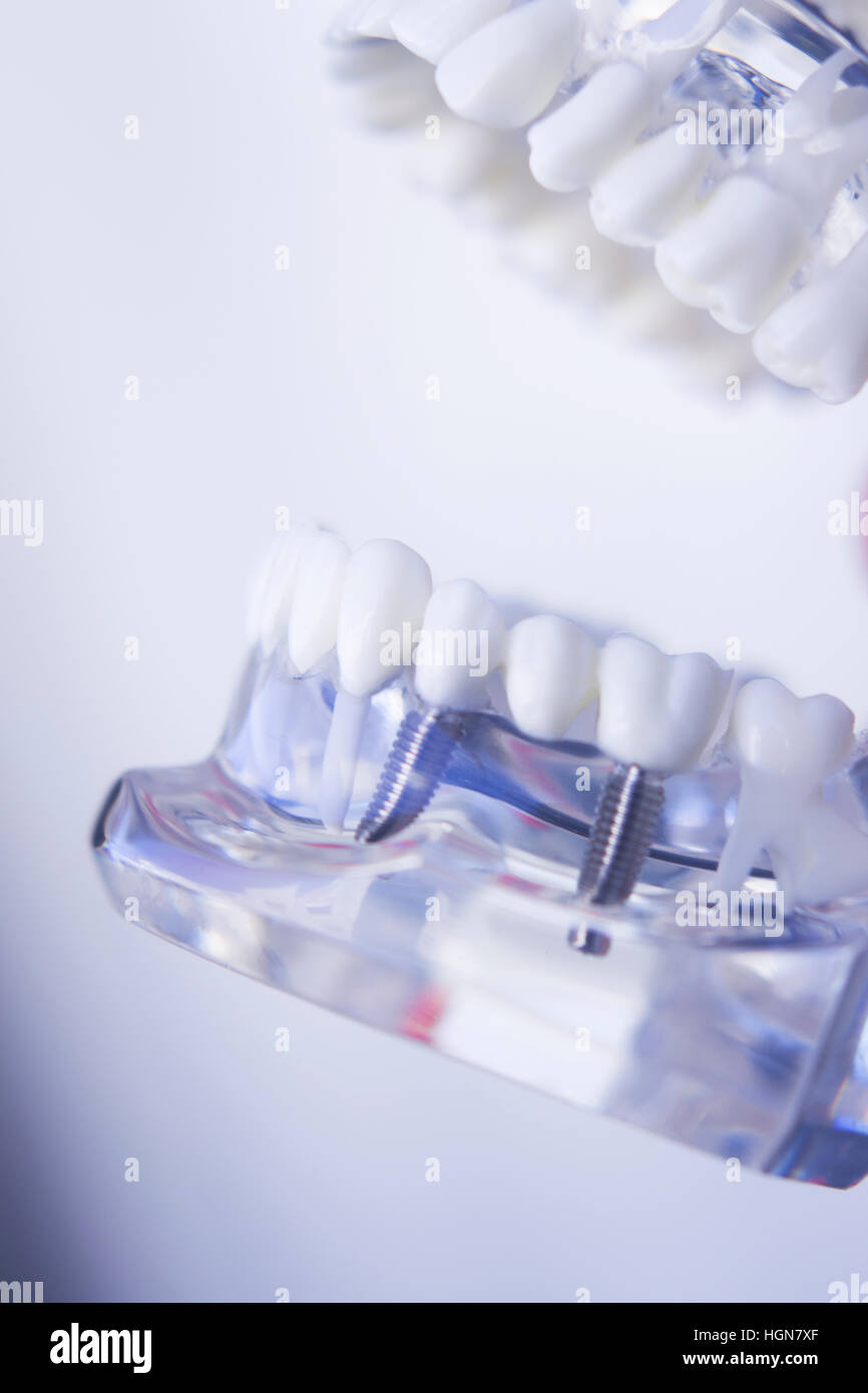 Dentists tooth plastic model with screw implant for teaching, learning ...