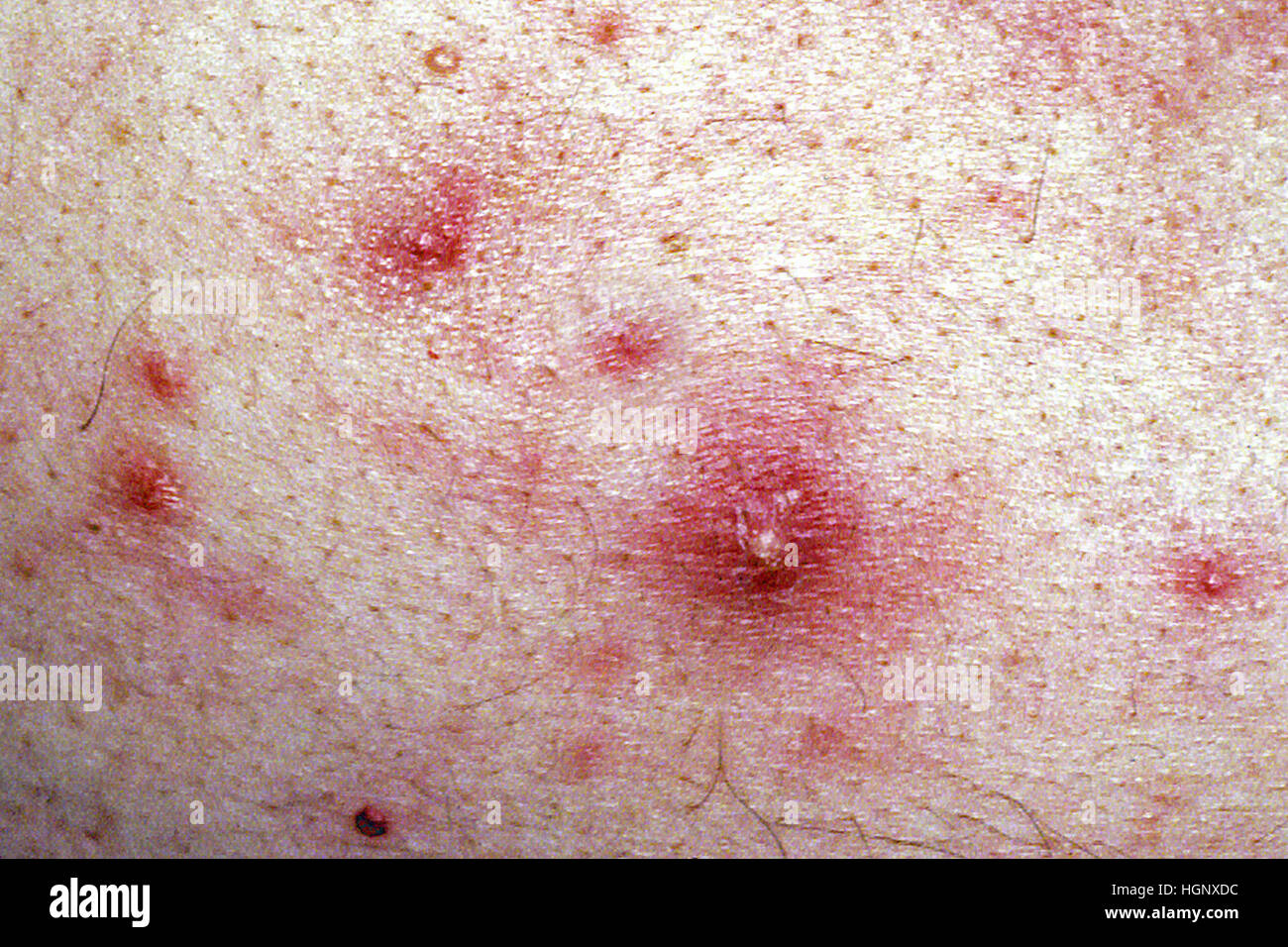 Pustules hi-res stock photography and images - Alamy