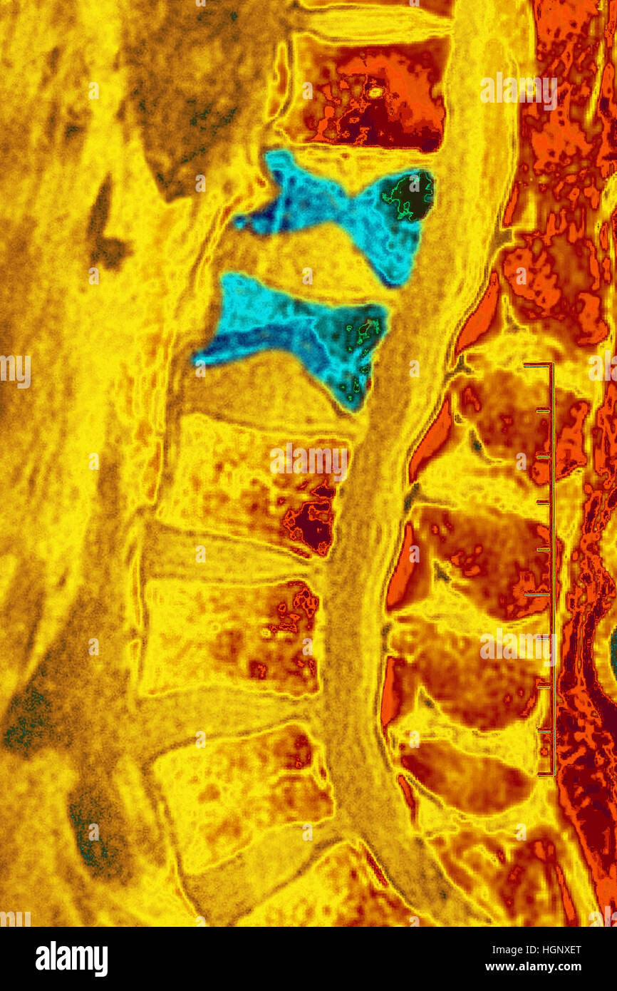 Compression fracture spine hi-res stock photography and images - Alamy