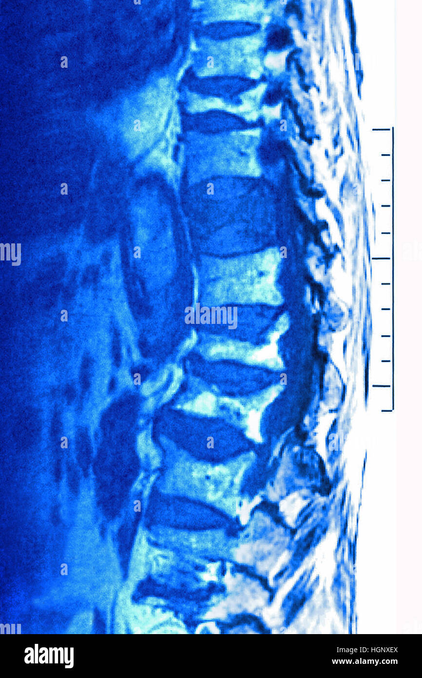Thoracic spine vertebrae fracture hi-res stock photography and images ...