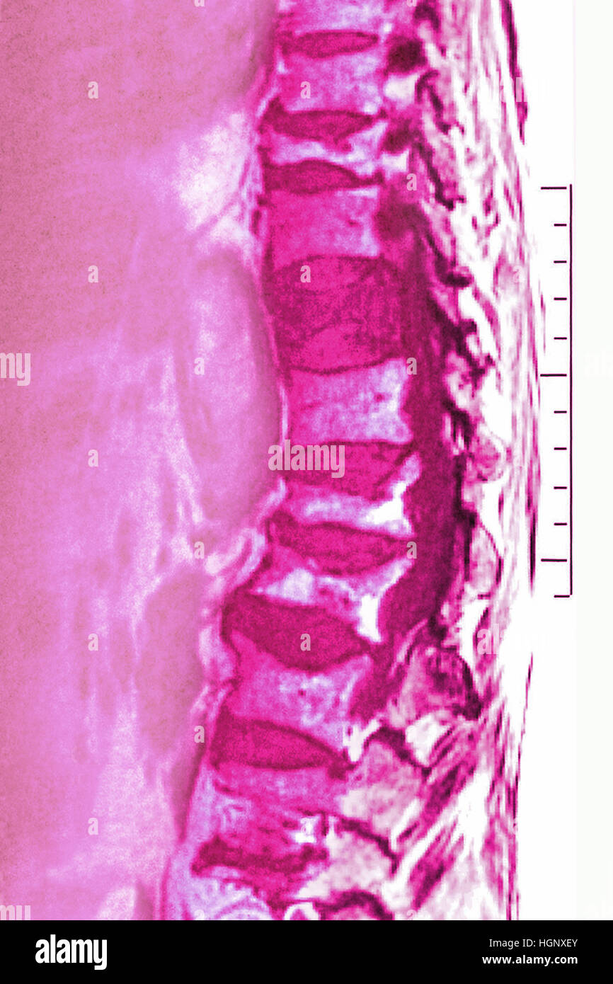 Compression Fracture Spine High Resolution Stock Photography and Images ...
