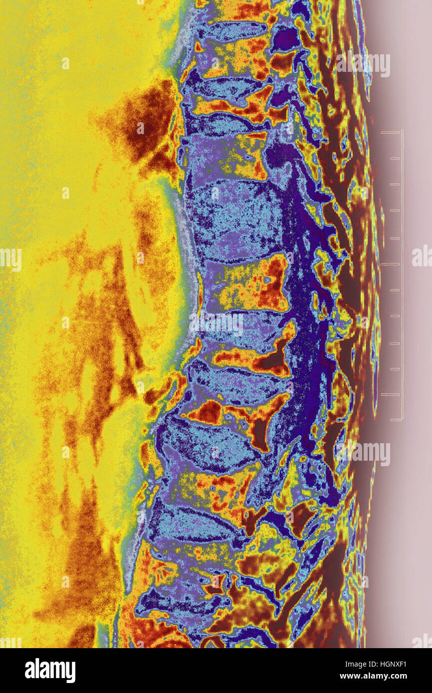 Thoracic vertebrae compression fracture hi-res stock photography and ...