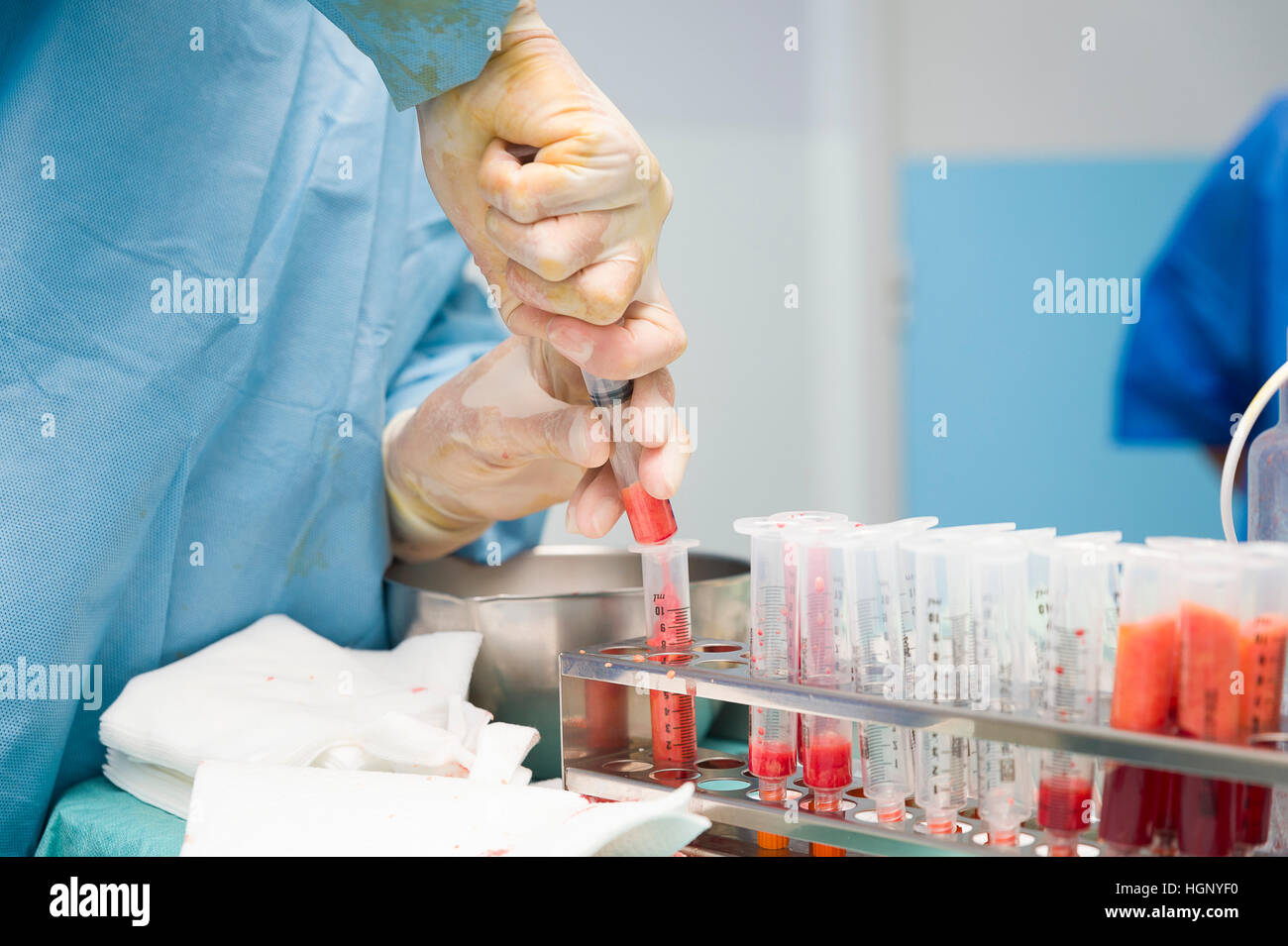 Lipofilling hi-res stock photography and images - Alamy