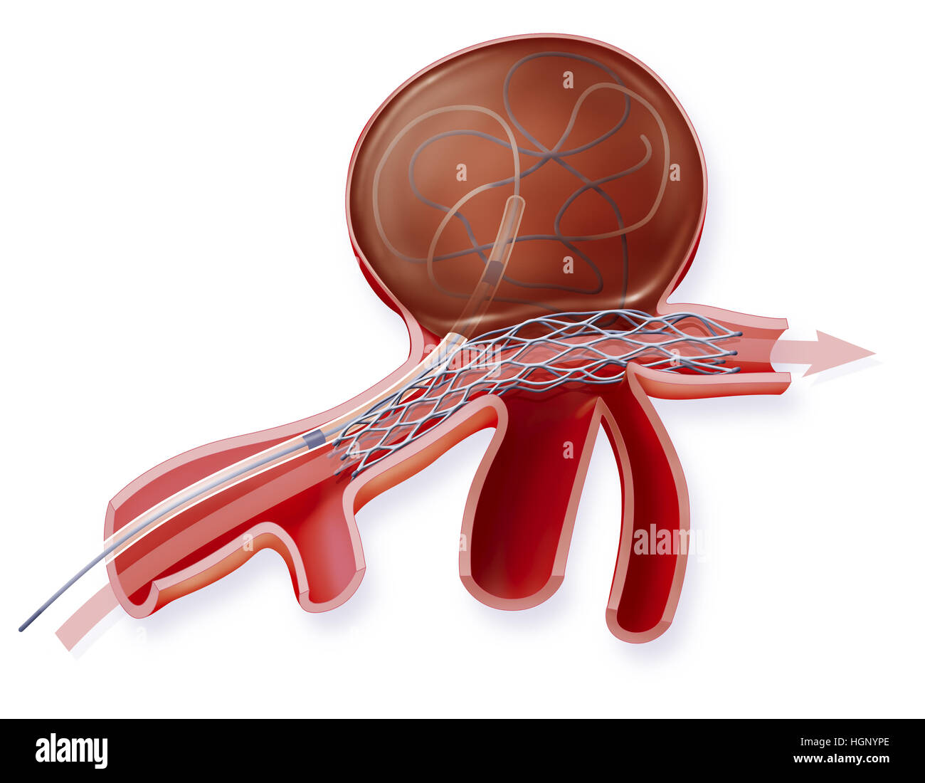 Aneurysm Stock Photos & Aneurysm Stock Images - Alamy