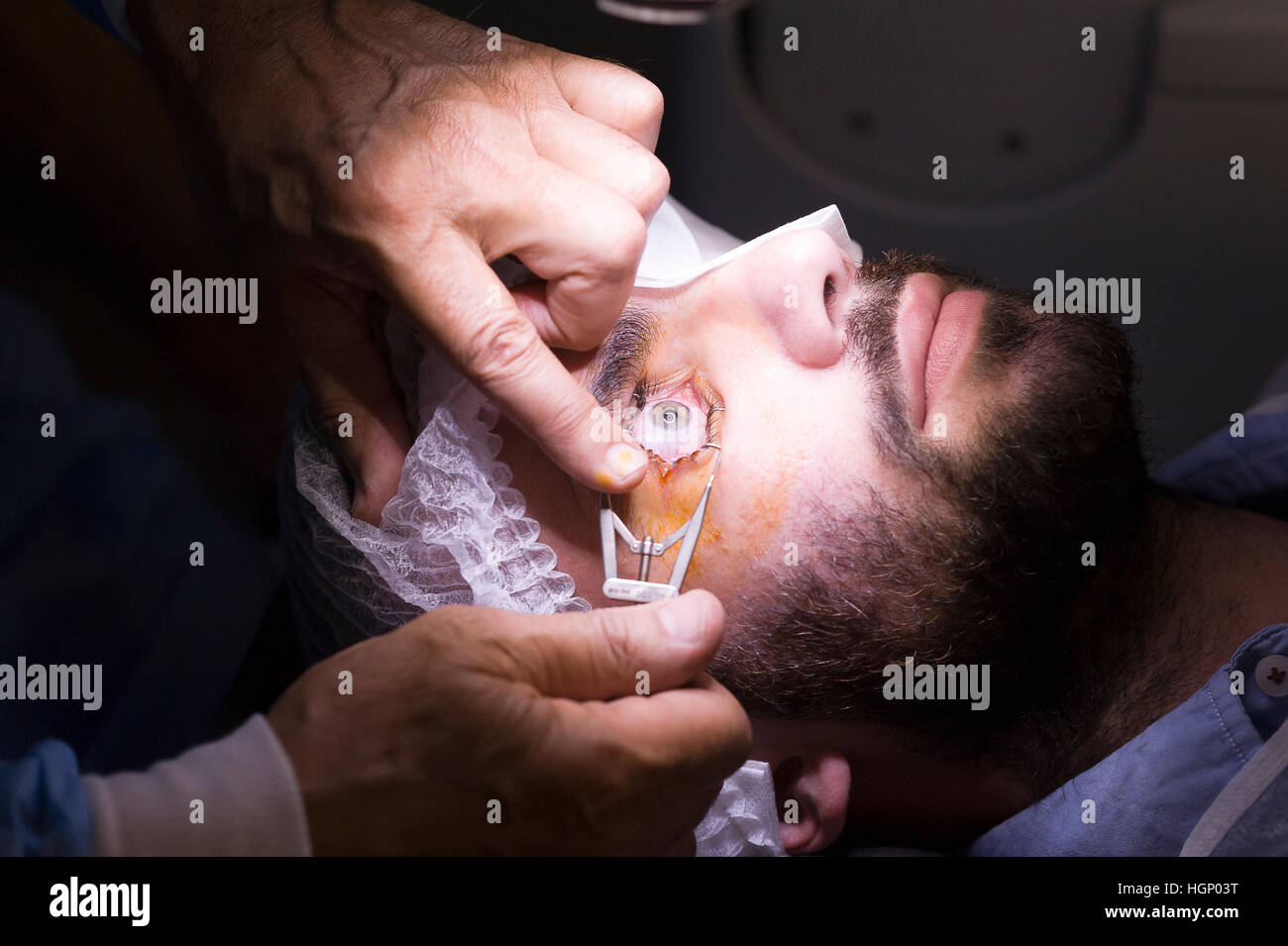 EYE LASER SURGERY Stock Photo - Alamy