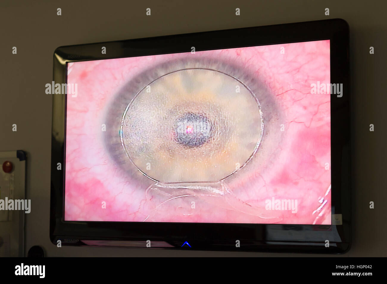 EYE LASER SURGERY Stock Photo - Alamy