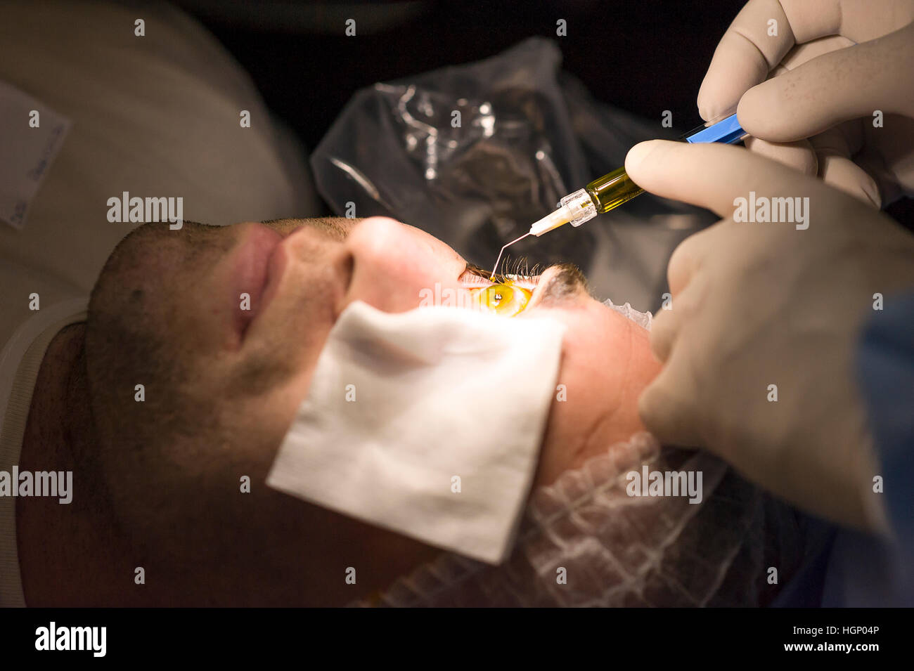 EYE LASER SURGERY Stock Photo - Alamy