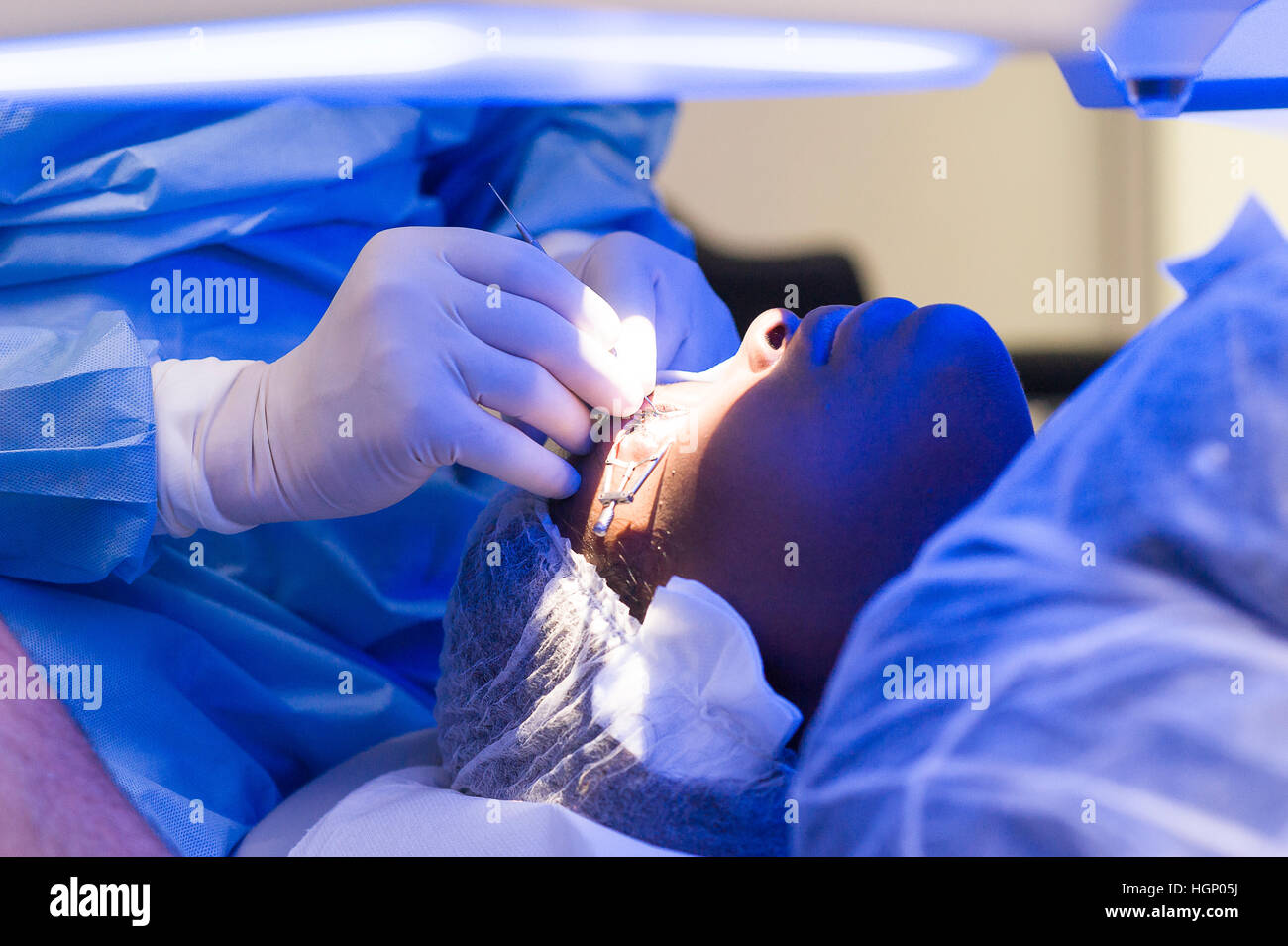 EYE LASER SURGERY Stock Photo - Alamy