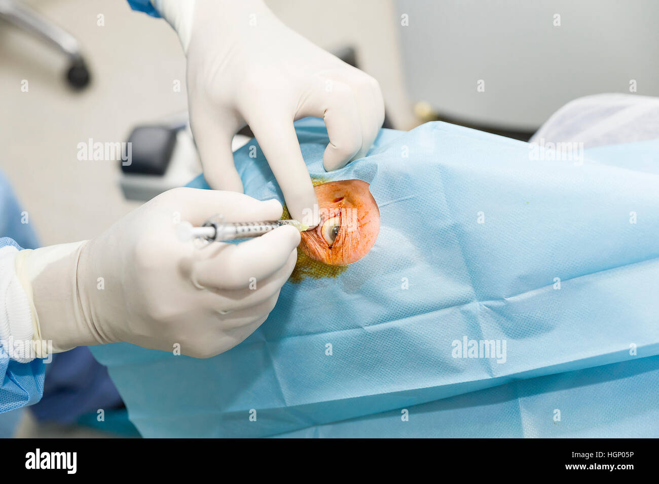 EYE LASER SURGERY Stock Photo - Alamy