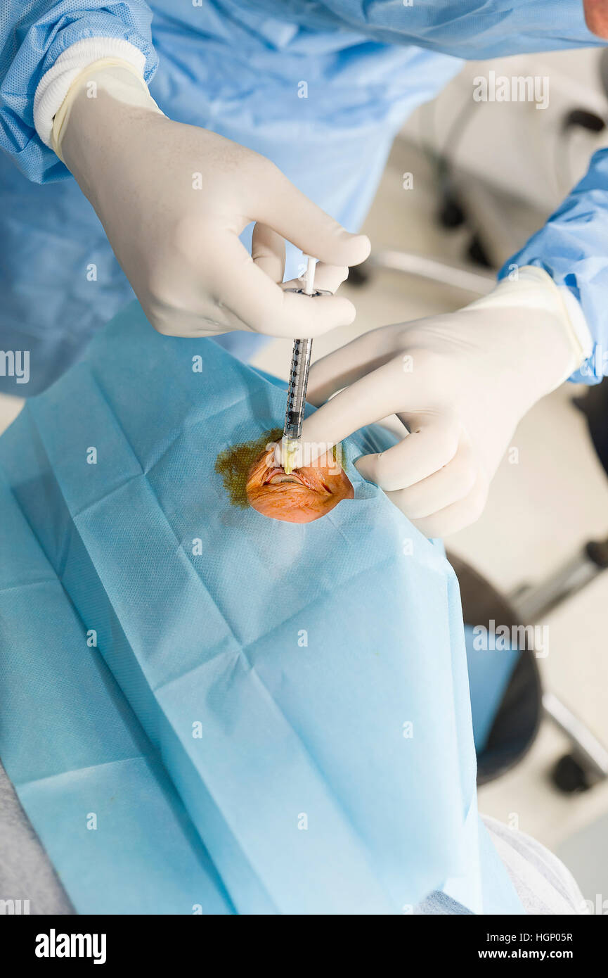 EYE LASER SURGERY Stock Photo - Alamy