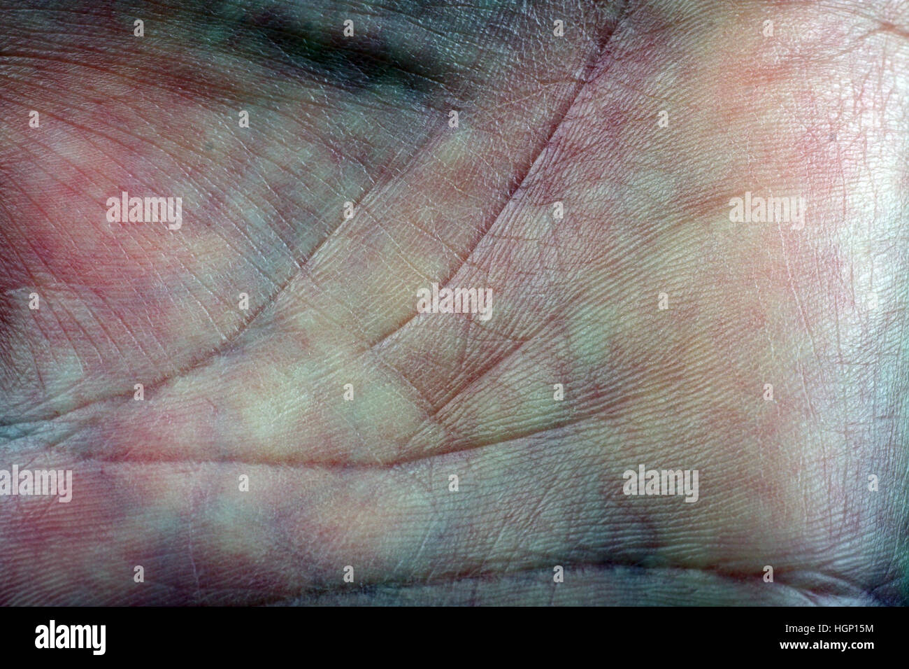 Bruised skin hi-res stock photography and images - Alamy