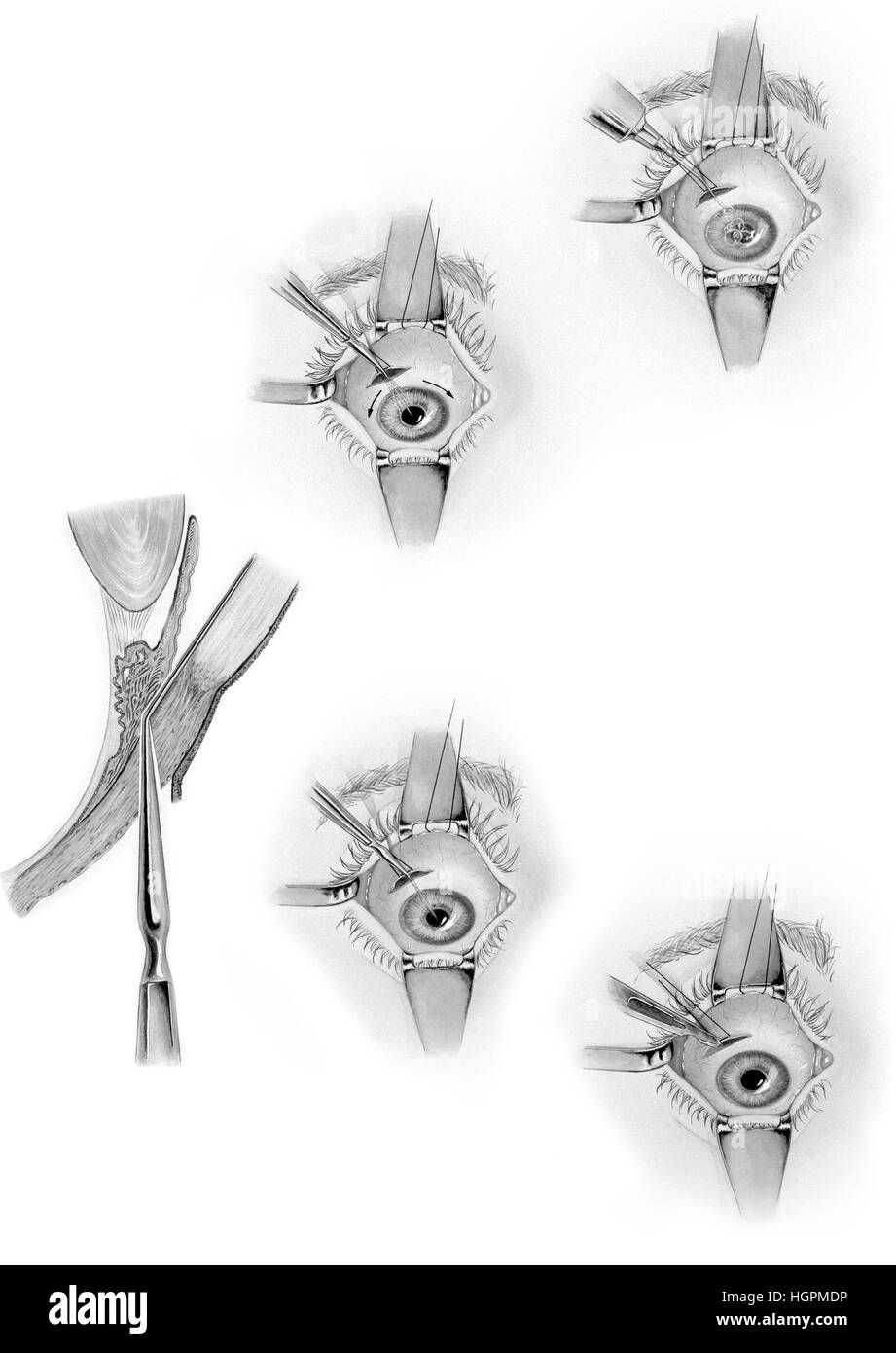 Five steps of cataract surgery. A cataract is an eye disease in which ...