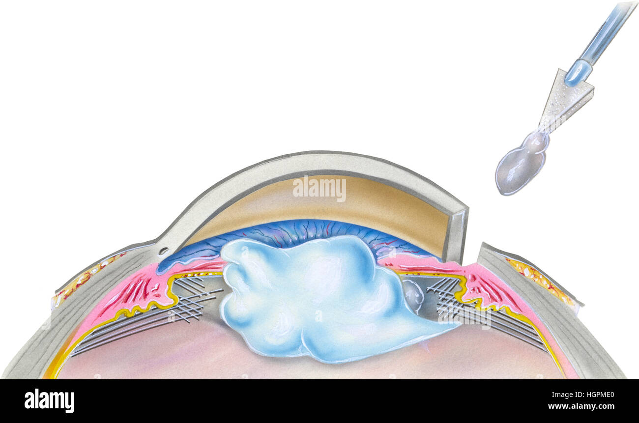Cataracts cloudy eye hi-res stock photography and images - Alamy