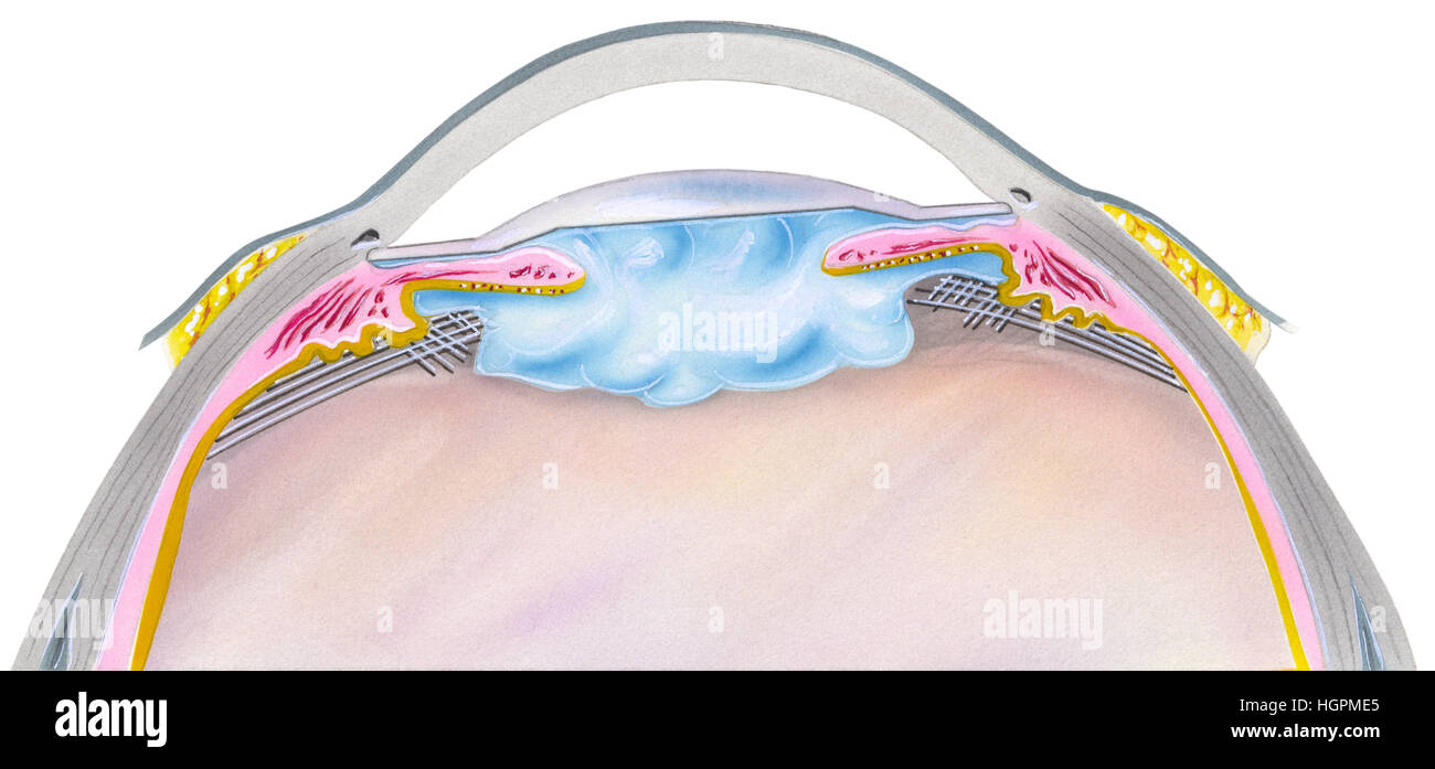 Step 7 of 7 A cataract is an eye disease in which the normally clear ...