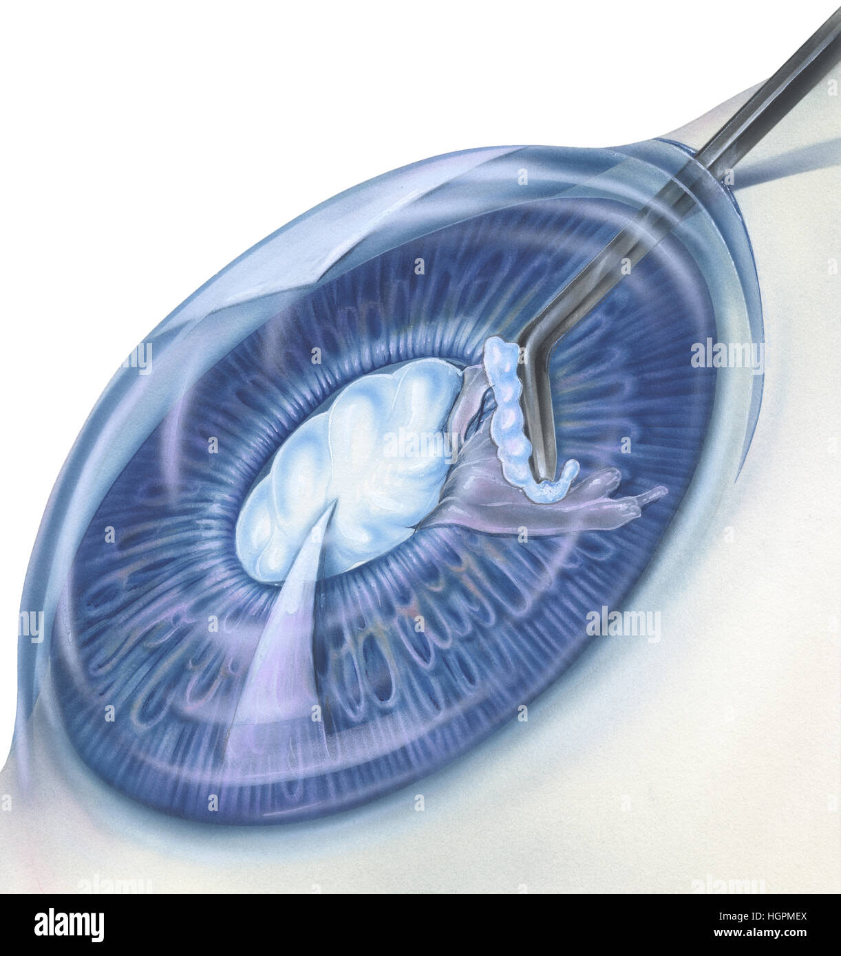 Cataract eye human cloudy hi-res stock photography and images - Alamy