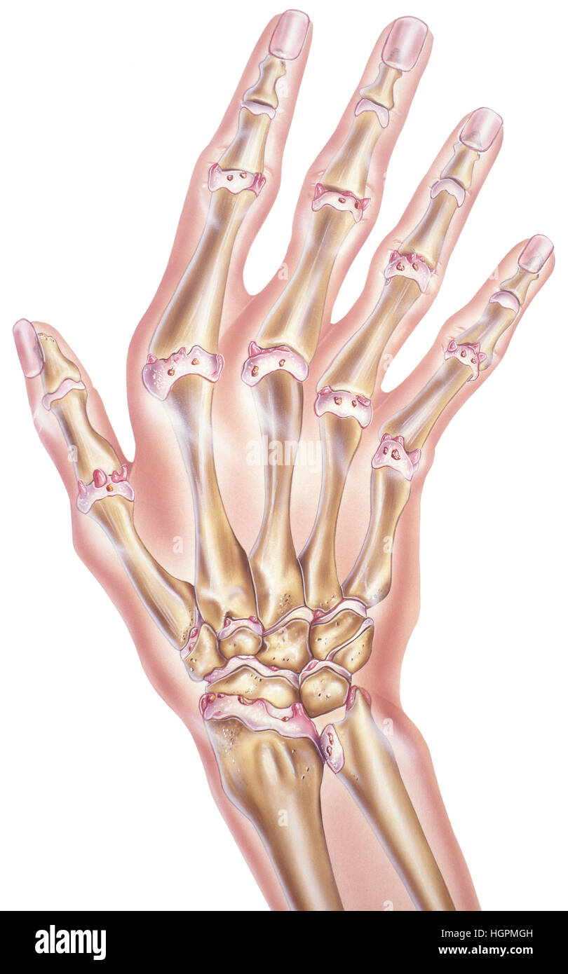 Shown is a hand with severe arthritis of the joints, This would cause ...