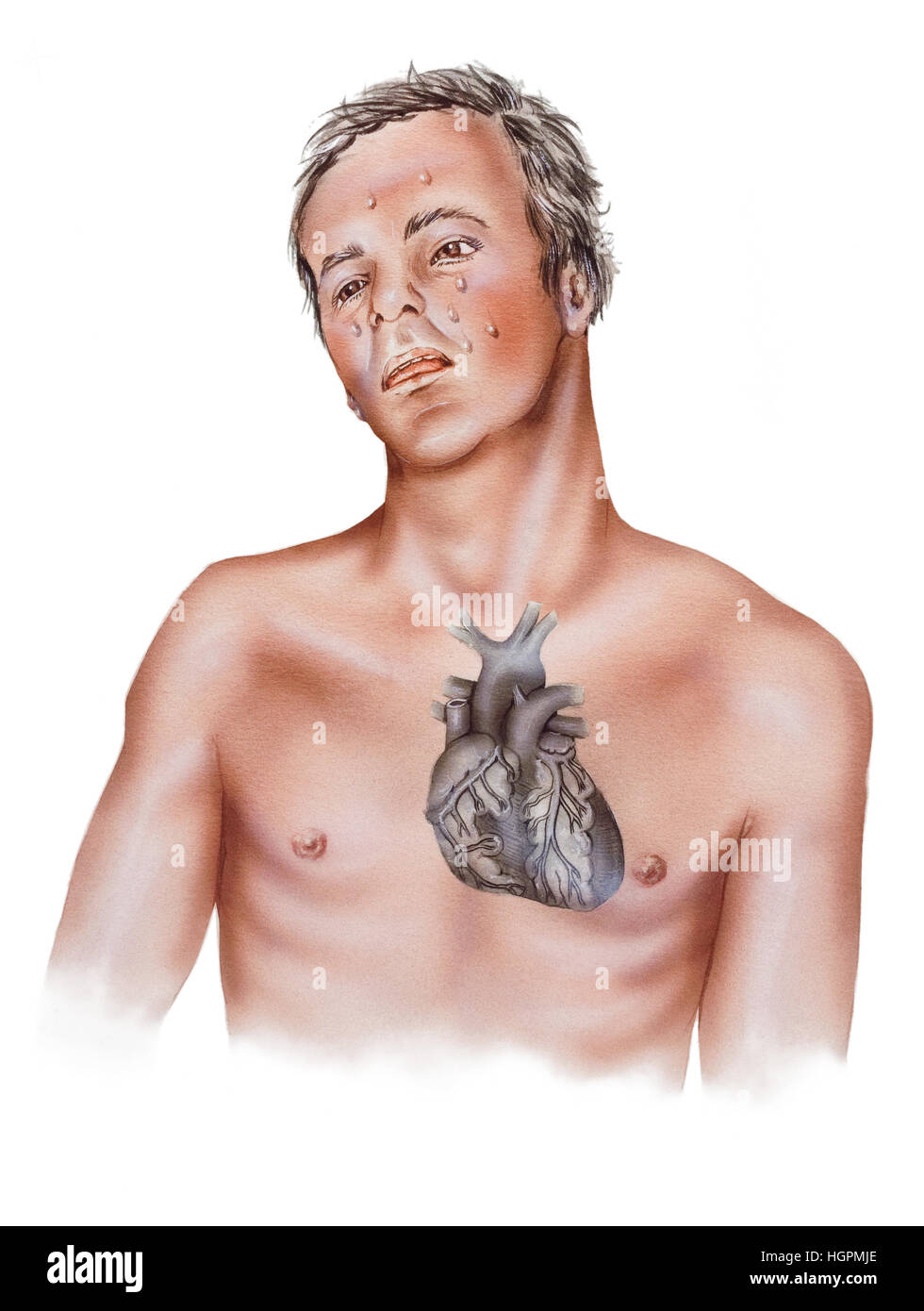 Heart attack symptoms in a male patient: sweating, shortness of breath ...