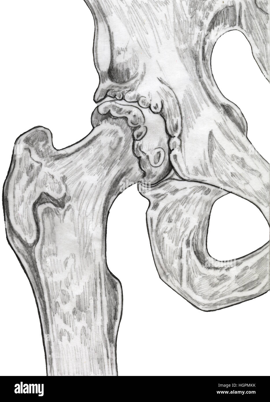 Hip bones showing the effects of arthritis Stock Photo - Alamy