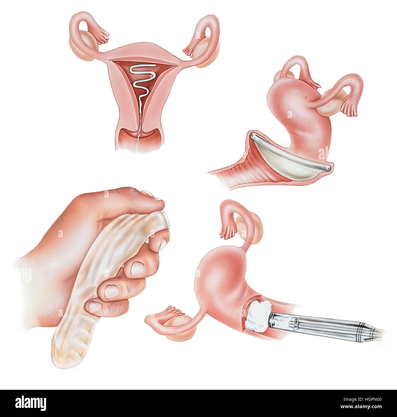 Reproduction Contraceptive Methods other Than The Pill Various reproduction-contraceptive-methods-other-than-the-pill-various